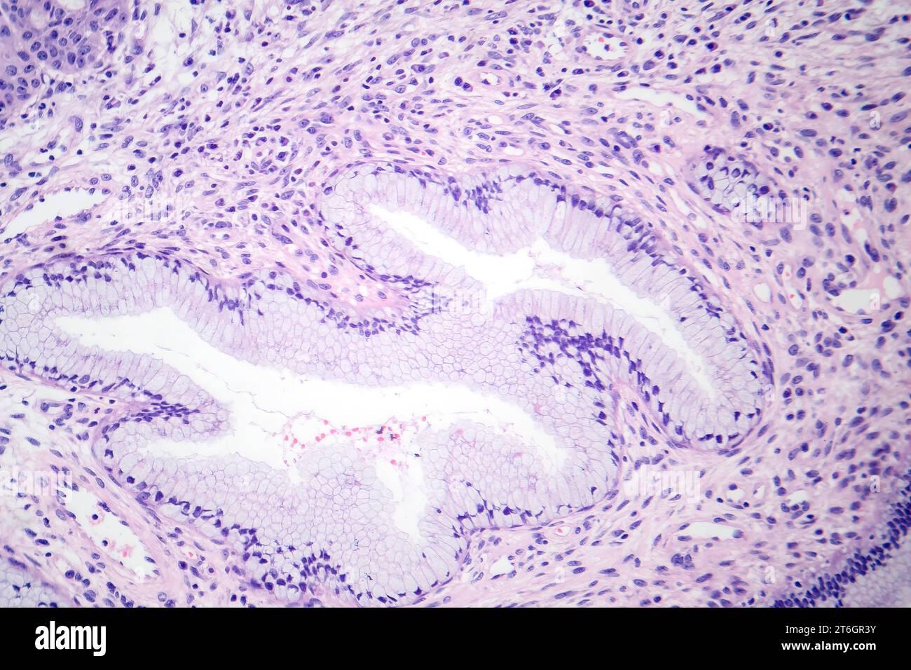 Photomicrograph of nasal polyps, displaying abnormal tissue growth in ...