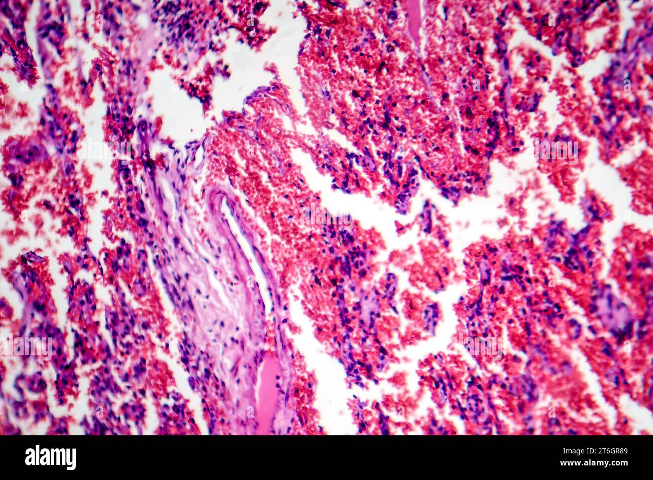 Photomicrograph of acute pulmonary hemorrhage, showing blood-filled ...