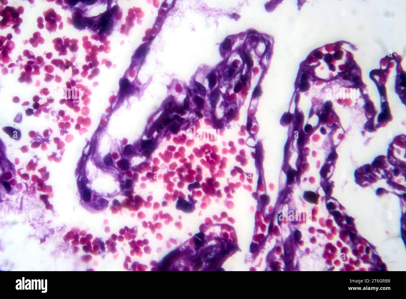 Photomicrograph of smoker's lung, revealing characteristic changes and ...