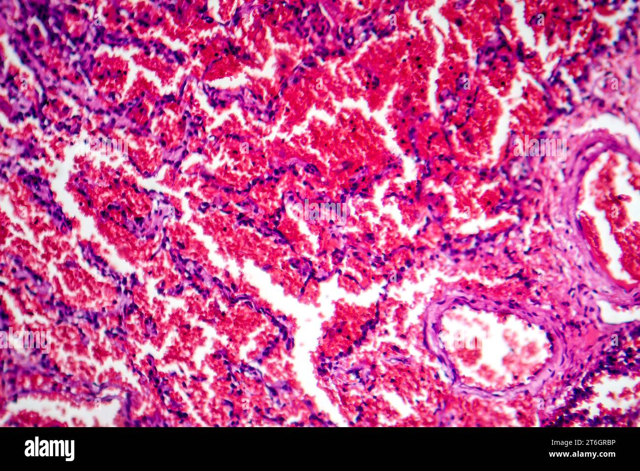 Photomicrograph of acute pulmonary hemorrhage, showing blood-filled ...