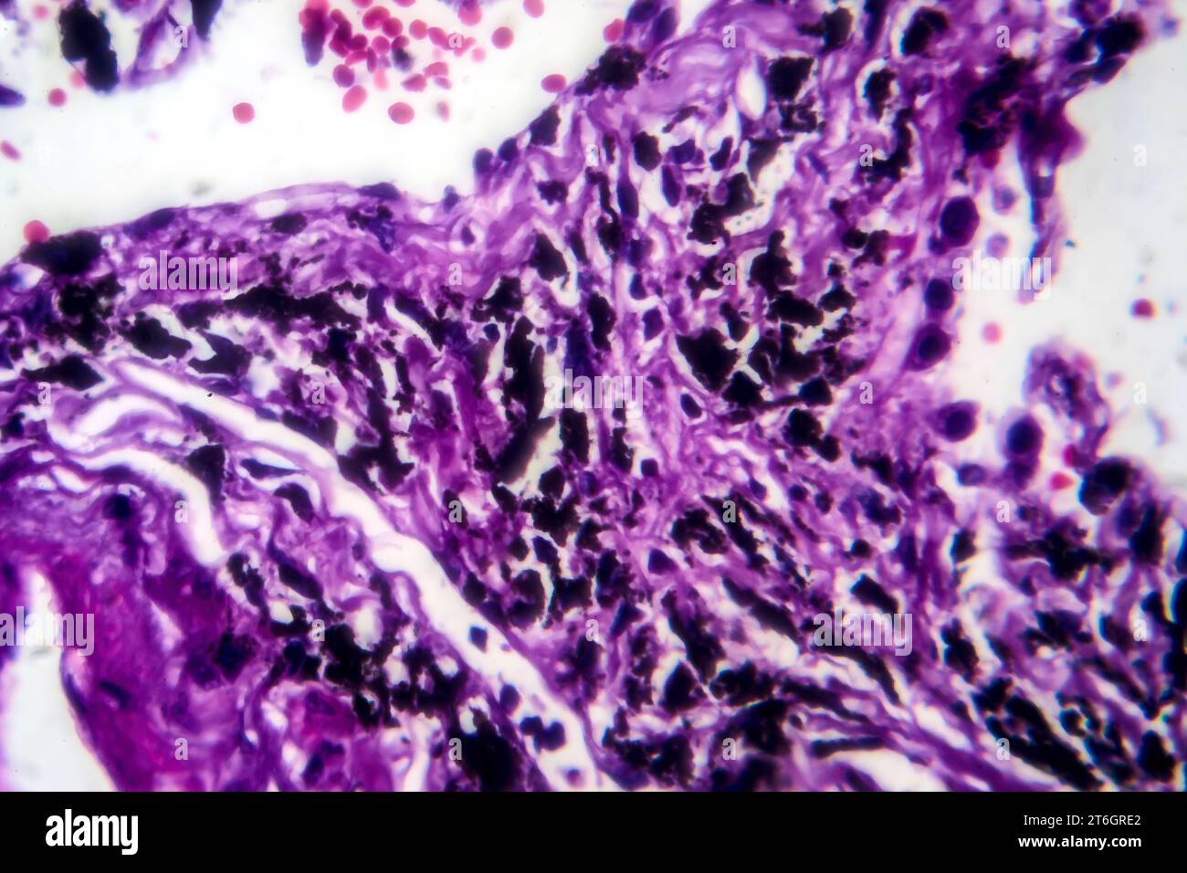 Emphysema lung microscope hi-res stock photography and images - Alamy