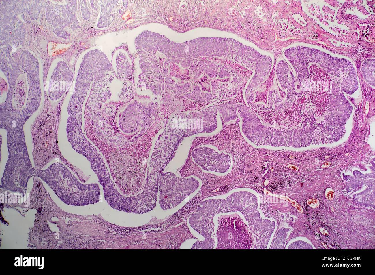 Photomicrograph of lung adenocarcinoma, illustrating malignant ...