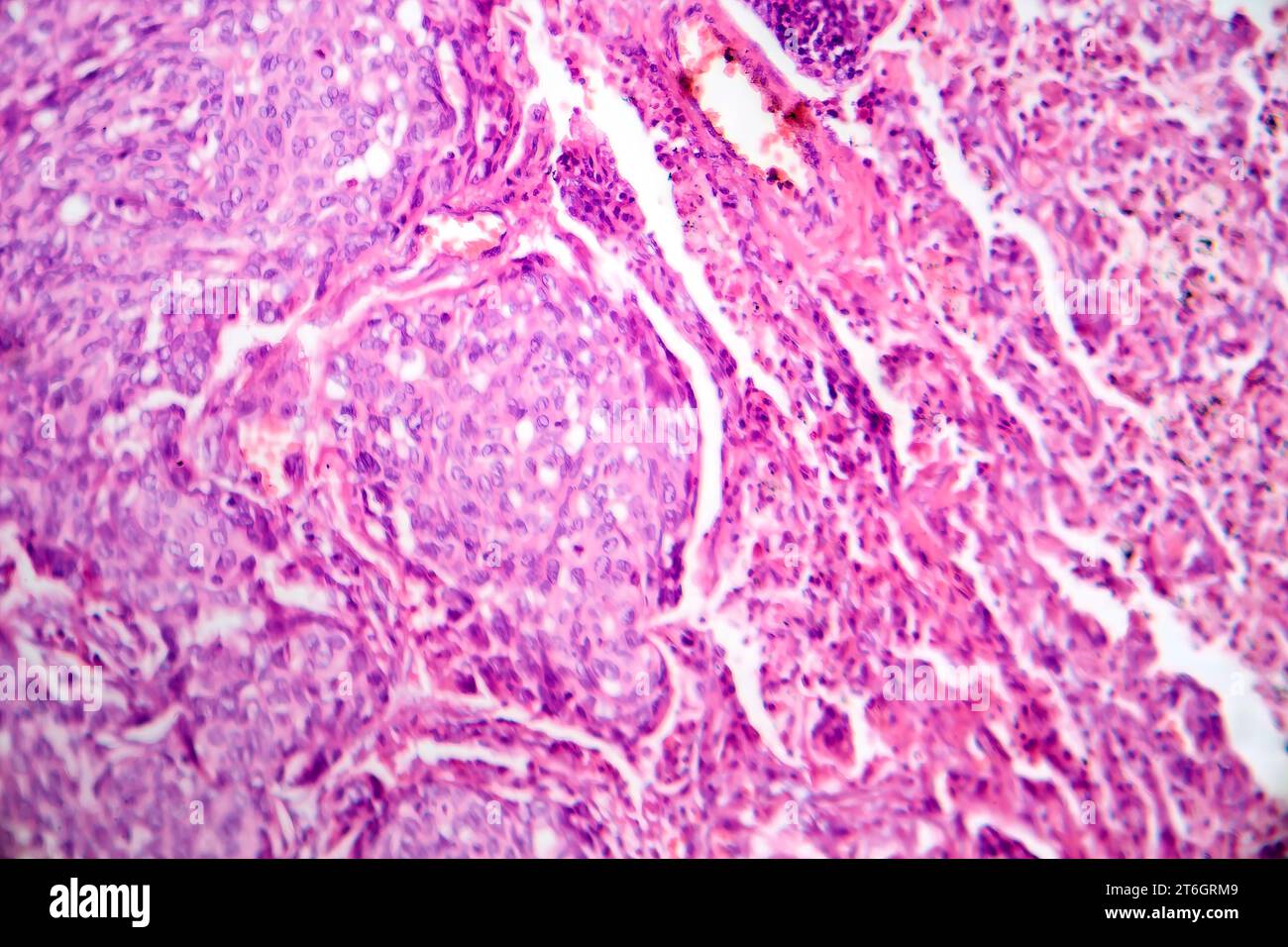 Photomicrograph of lung adenocarcinoma, illustrating malignant ...