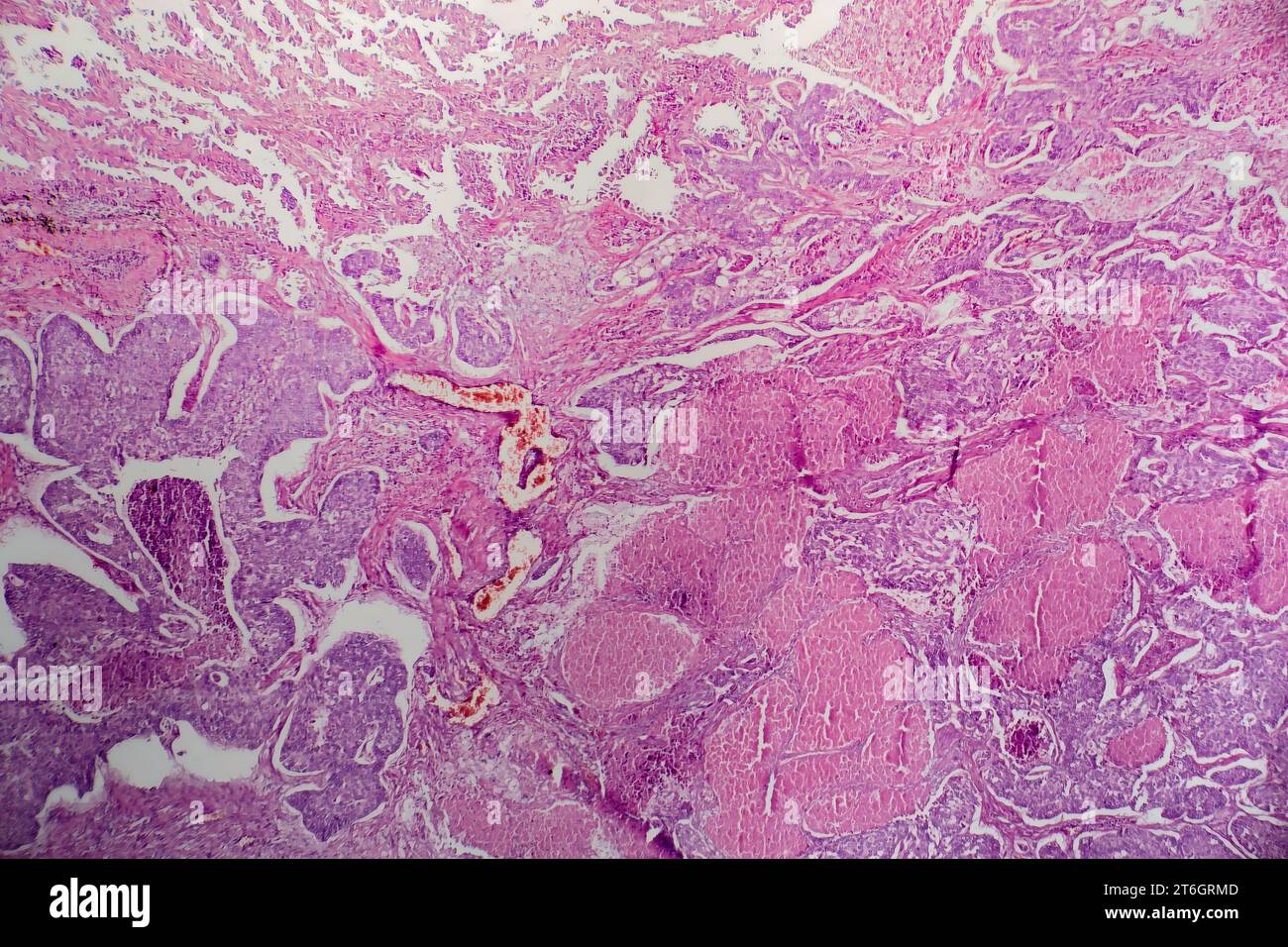 Photomicrograph of lung adenocarcinoma, illustrating malignant ...