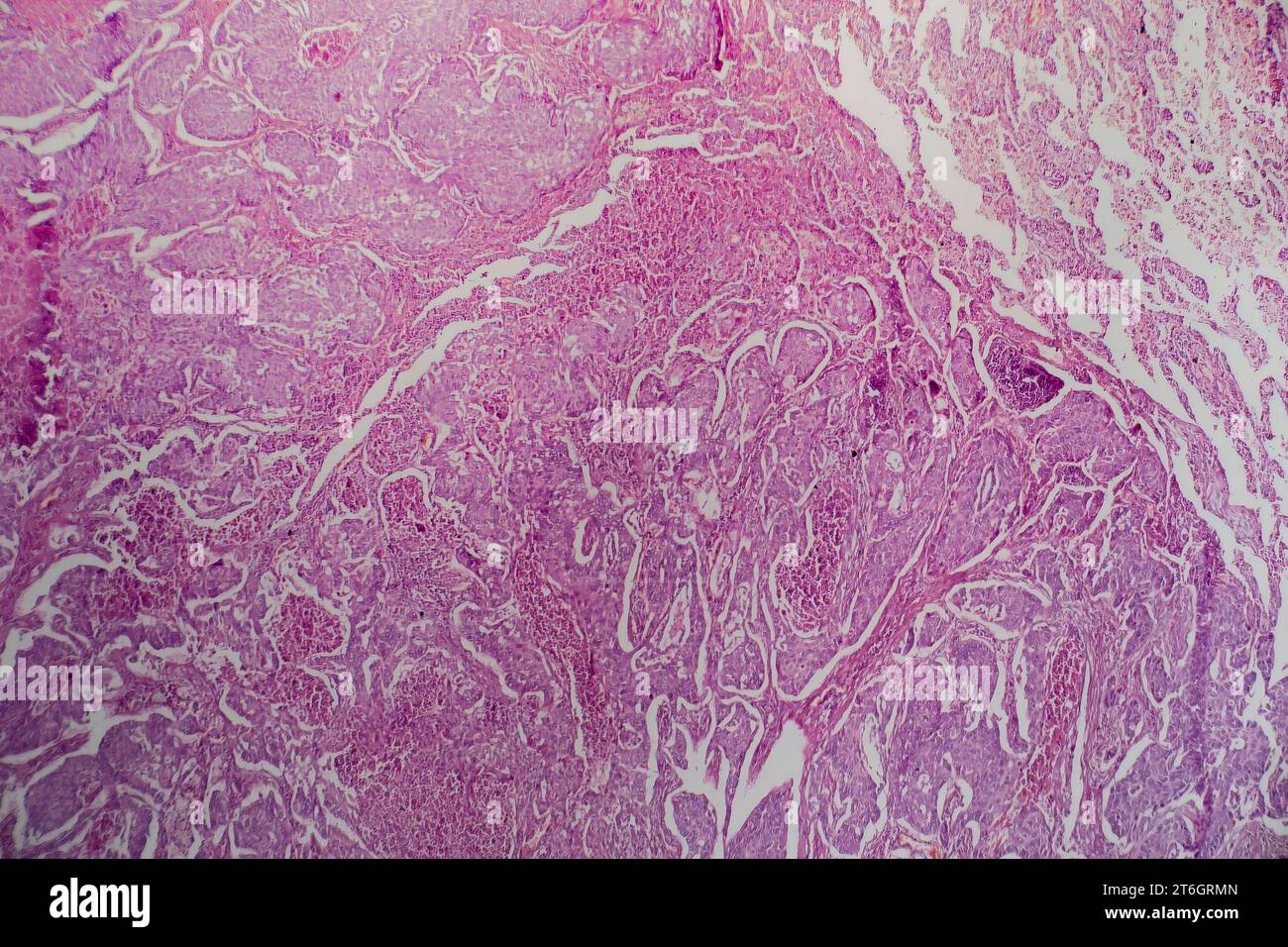 Photomicrograph of lung adenocarcinoma, illustrating malignant ...