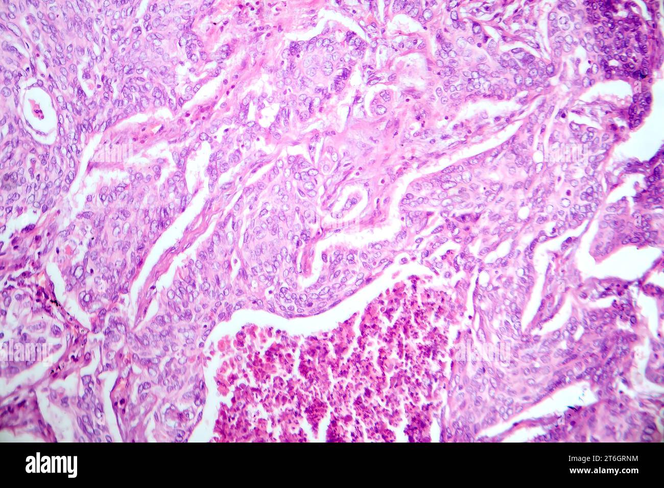 Photomicrograph of lung adenocarcinoma, illustrating malignant ...