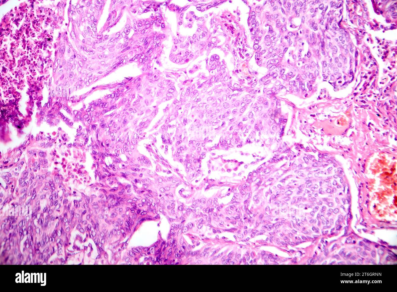 Photomicrograph of lung adenocarcinoma, illustrating malignant ...