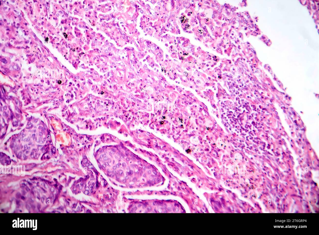 Photomicrograph of lung adenocarcinoma, illustrating malignant ...