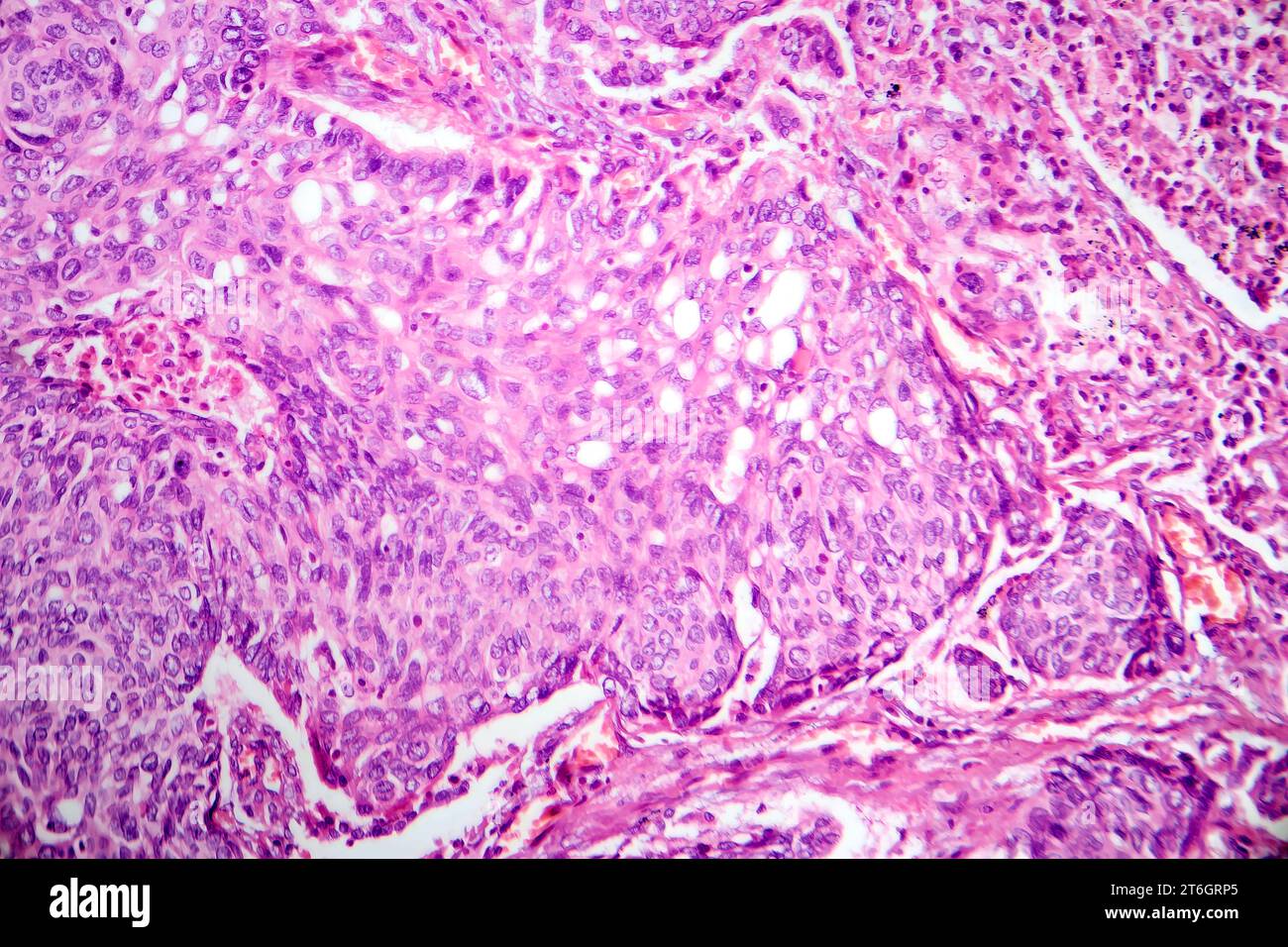 Photomicrograph of lung adenocarcinoma, illustrating malignant ...
