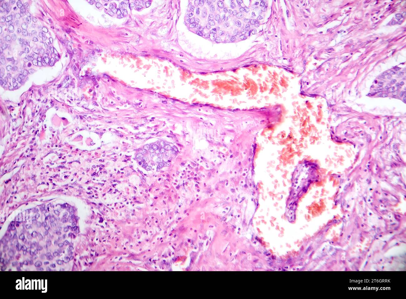 Photomicrograph of lung adenocarcinoma, illustrating malignant ...