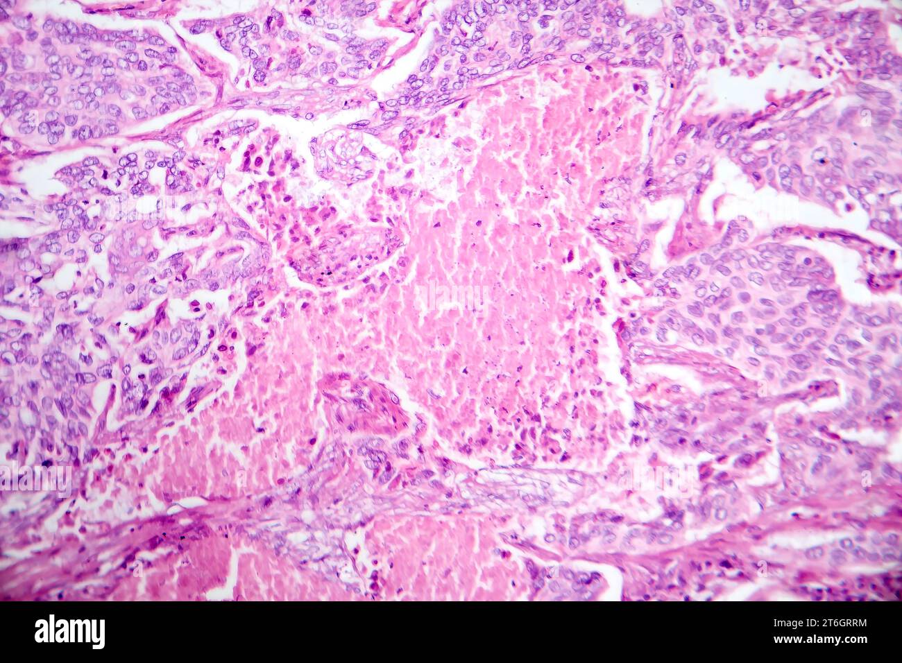 Photomicrograph of lung adenocarcinoma, illustrating malignant ...