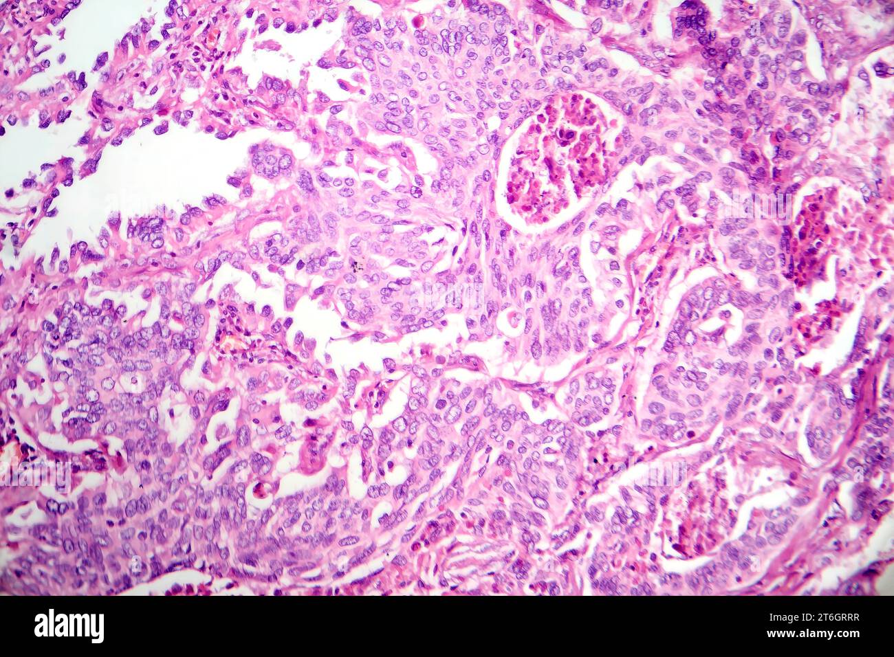 Photomicrograph of lung adenocarcinoma, illustrating malignant ...