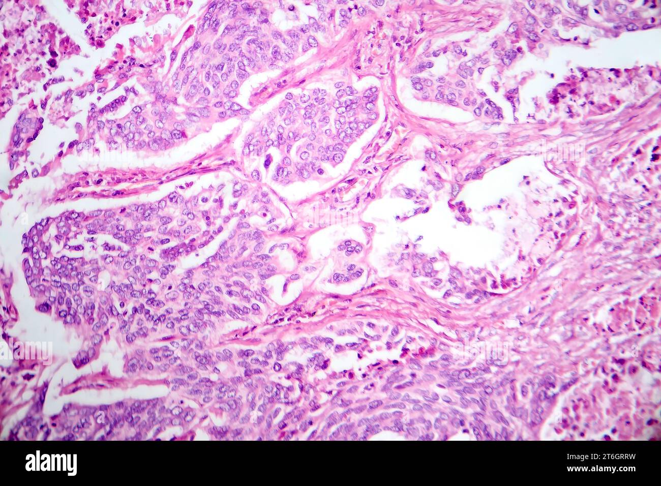 Photomicrograph of lung adenocarcinoma, illustrating malignant ...