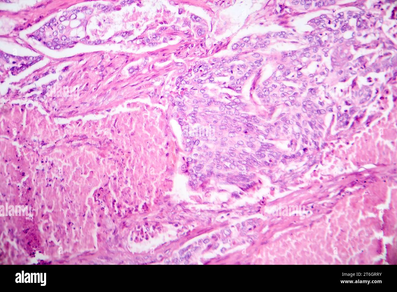 Photomicrograph of lung adenocarcinoma, illustrating malignant ...