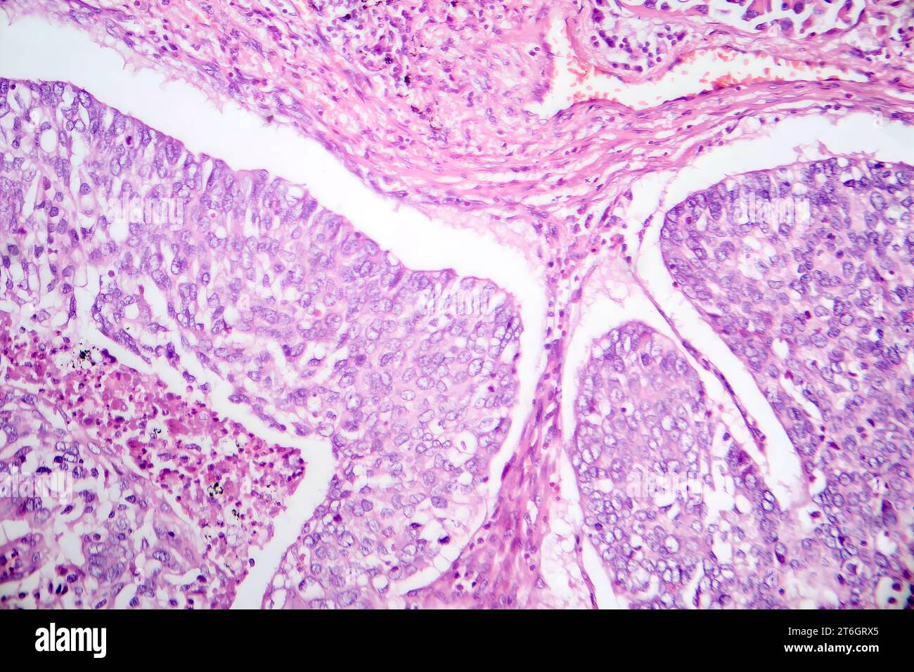 Photomicrograph of lung adenocarcinoma, illustrating malignant ...