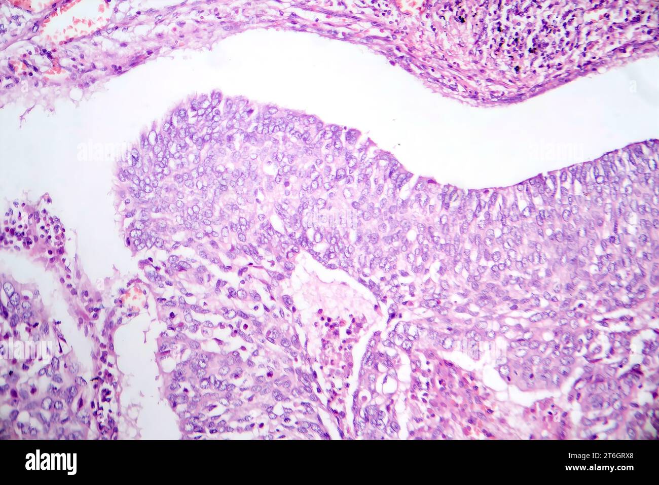 Photomicrograph of lung adenocarcinoma, illustrating malignant ...