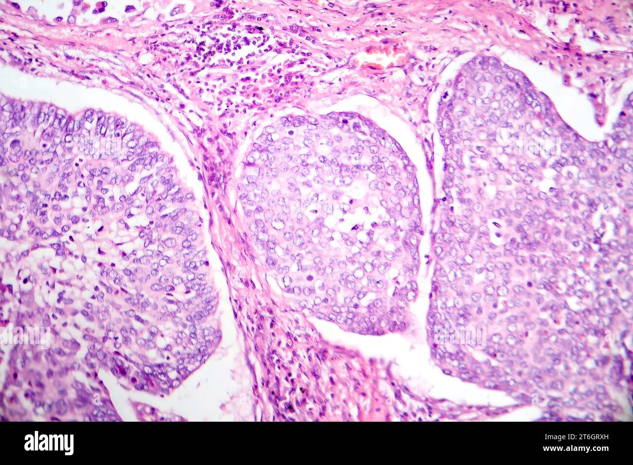 Photomicrograph of lung adenocarcinoma, illustrating malignant ...