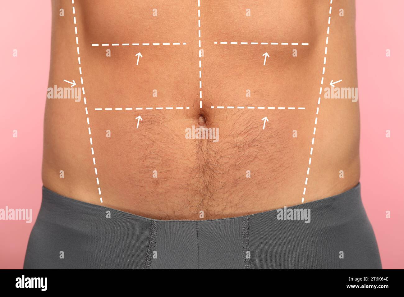 Man with markings for cosmetic surgery on his abdomen against pink ...