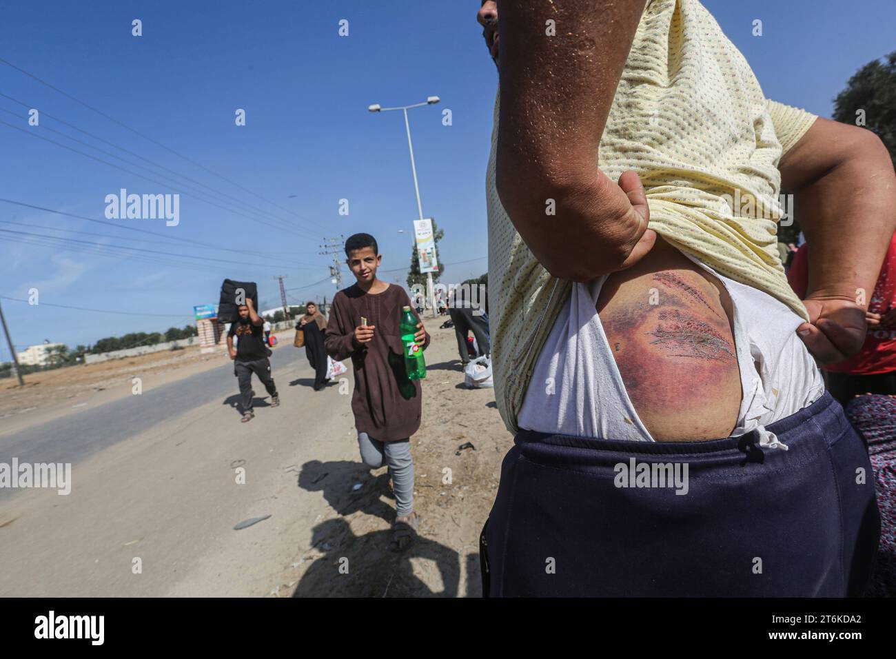 An injured Palestinian reveals his injury while escaping from the ...