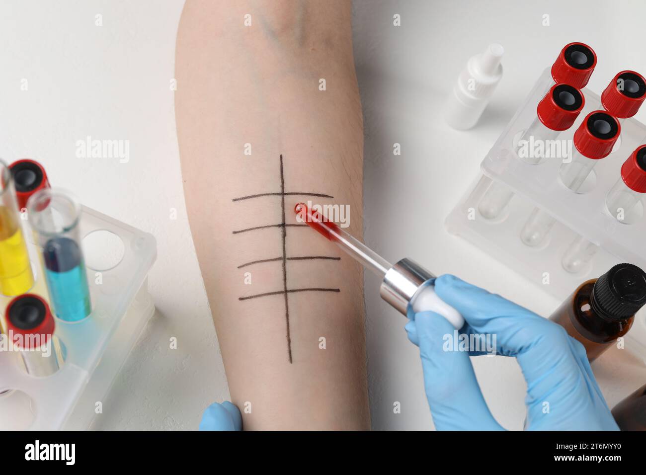 Doctor doing skin allergy test at light table, above view Stock Photo ...