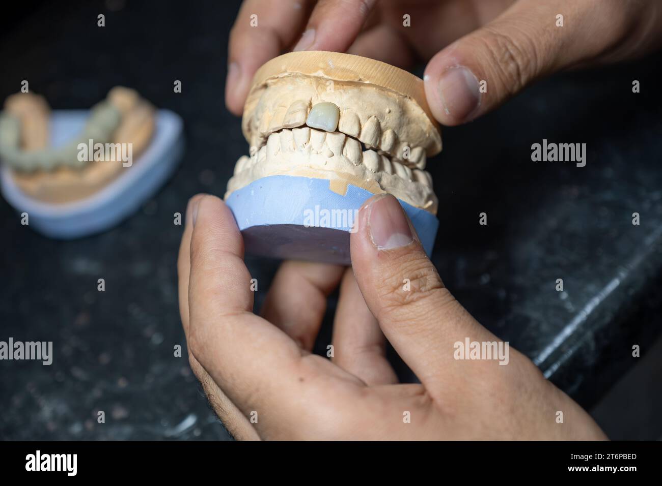 Dental gypsum models in dental laboratory with single tooth crown to be ...