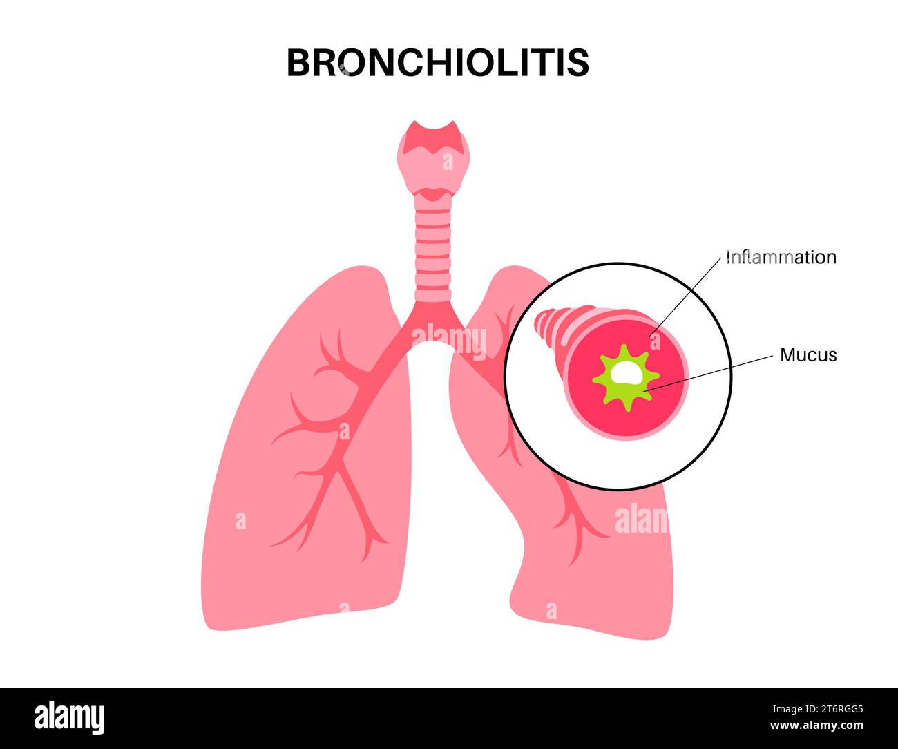 Bronchiolitis lung disease, illustration Stock Photo - Alamy