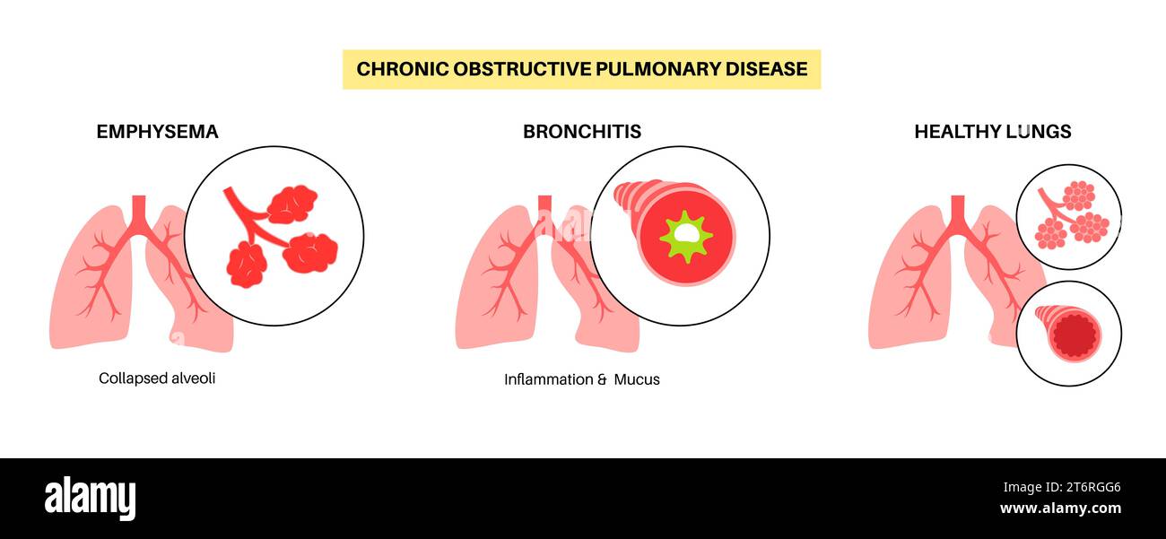 Chronic obstructive pulmonary disease, illustration Stock Photo - Alamy