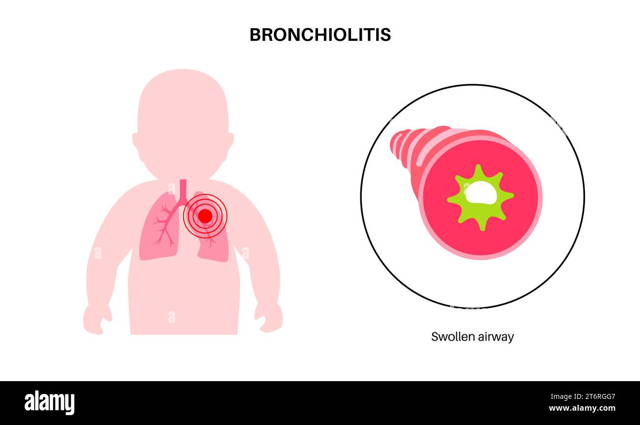 Bronchiolitis lung disease, illustration Stock Photo - Alamy