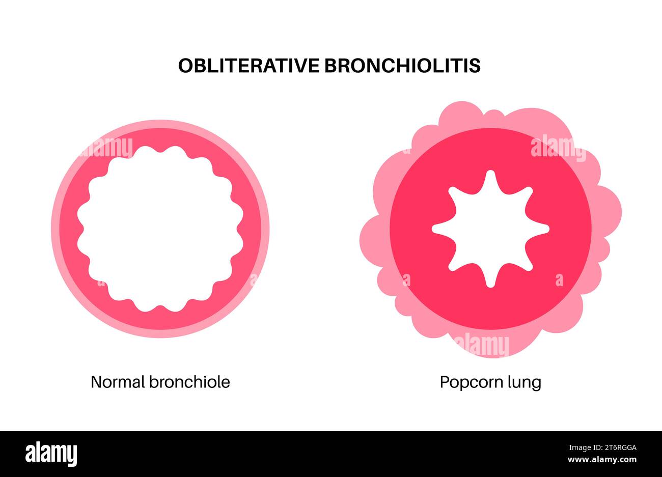 Bronchiolitis Cut Out Stock Images & Pictures - Alamy