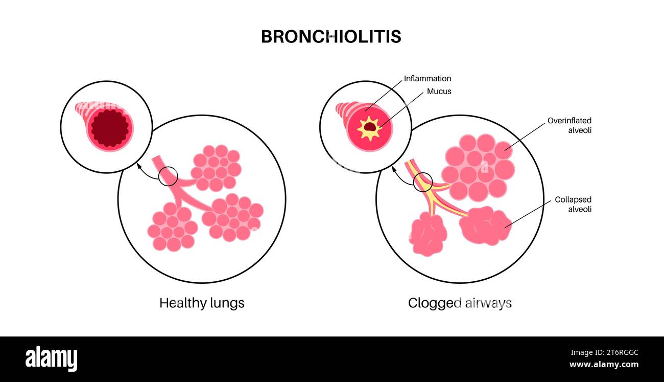Bronchiolitis lung disease, illustration Stock Photo - Alamy