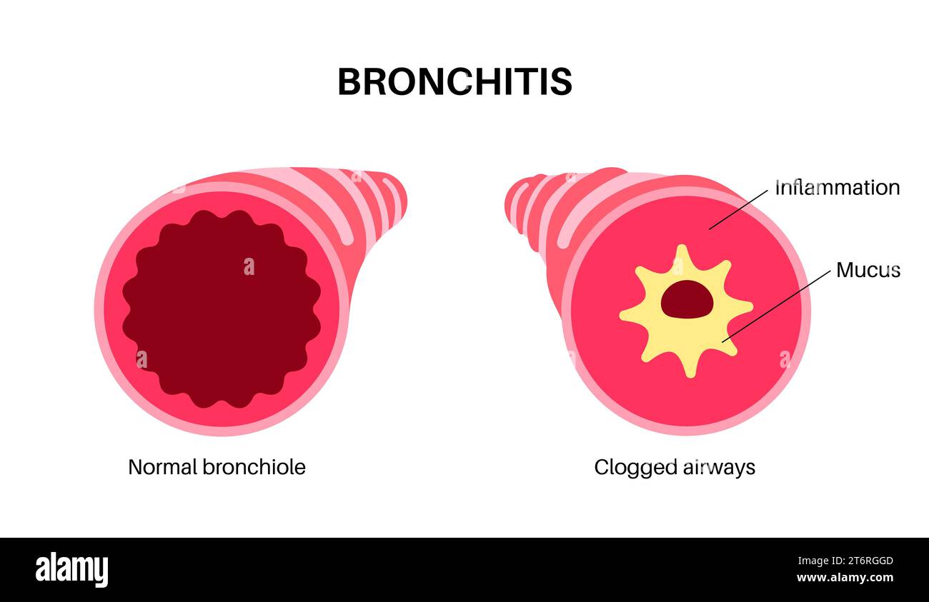 Bronchitis lung disease, illustration Stock Photo - Alamy
