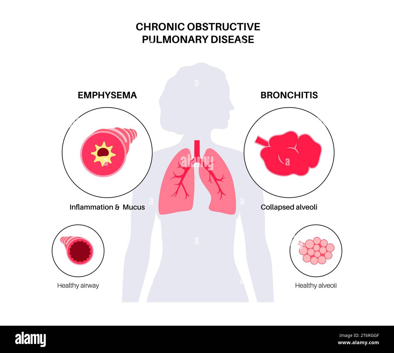 Chronic obstructive pulmonary disease, illustration Stock Photo - Alamy