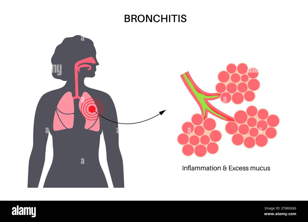 Bronchitis lung disease, illustration Stock Photo - Alamy