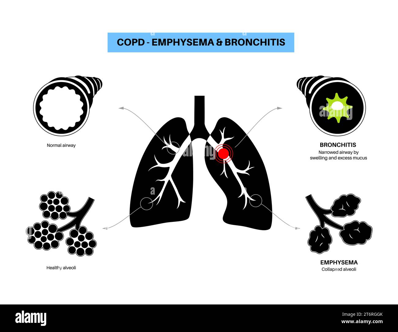 Chronic obstructive pulmonary disease, illustration Stock Photo - Alamy