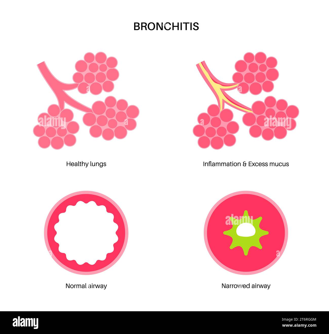 Bronchitis lung disease, illustration Stock Photo - Alamy