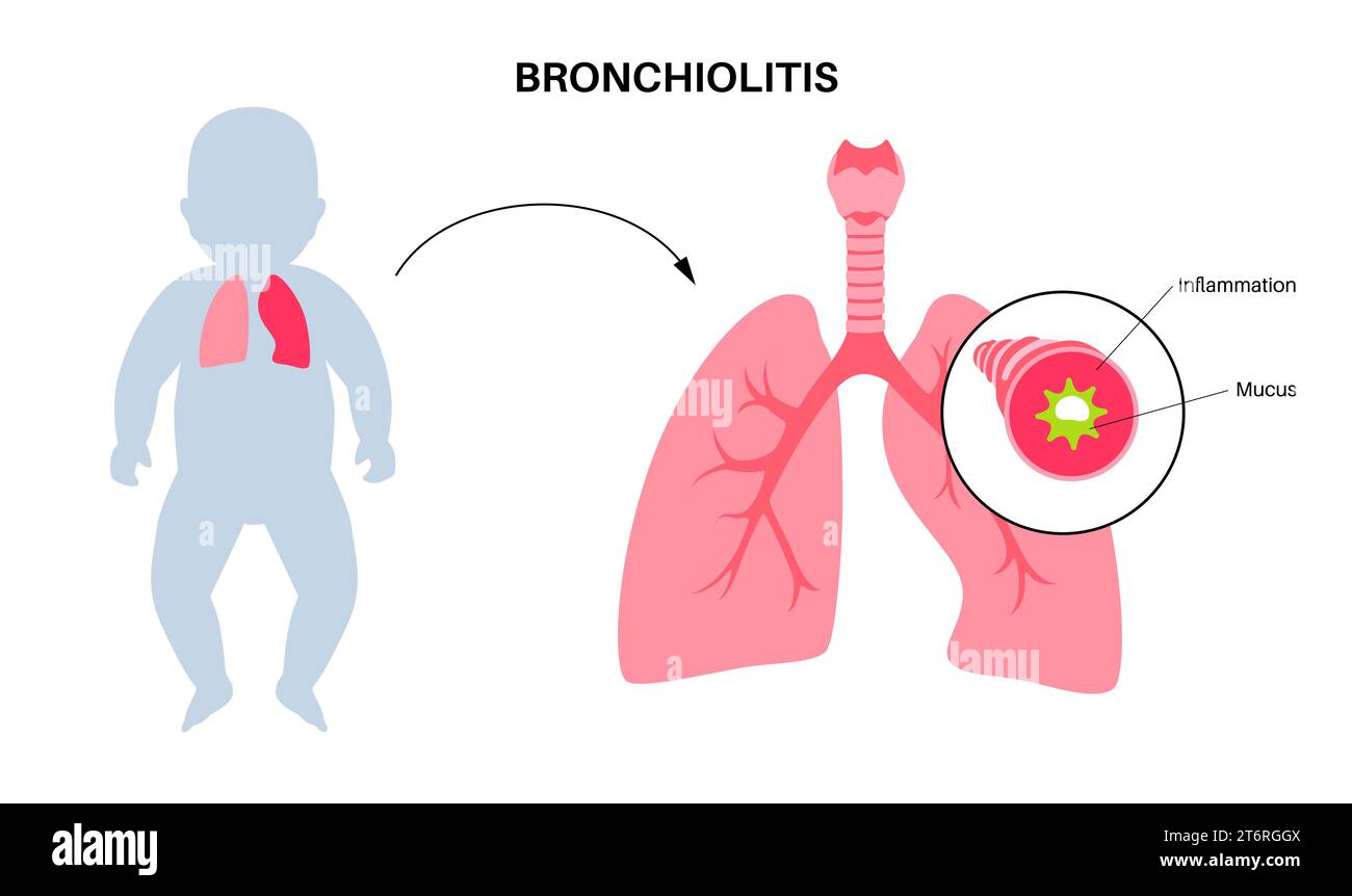 Bronchiolitis lung disease, illustration Stock Photo - Alamy