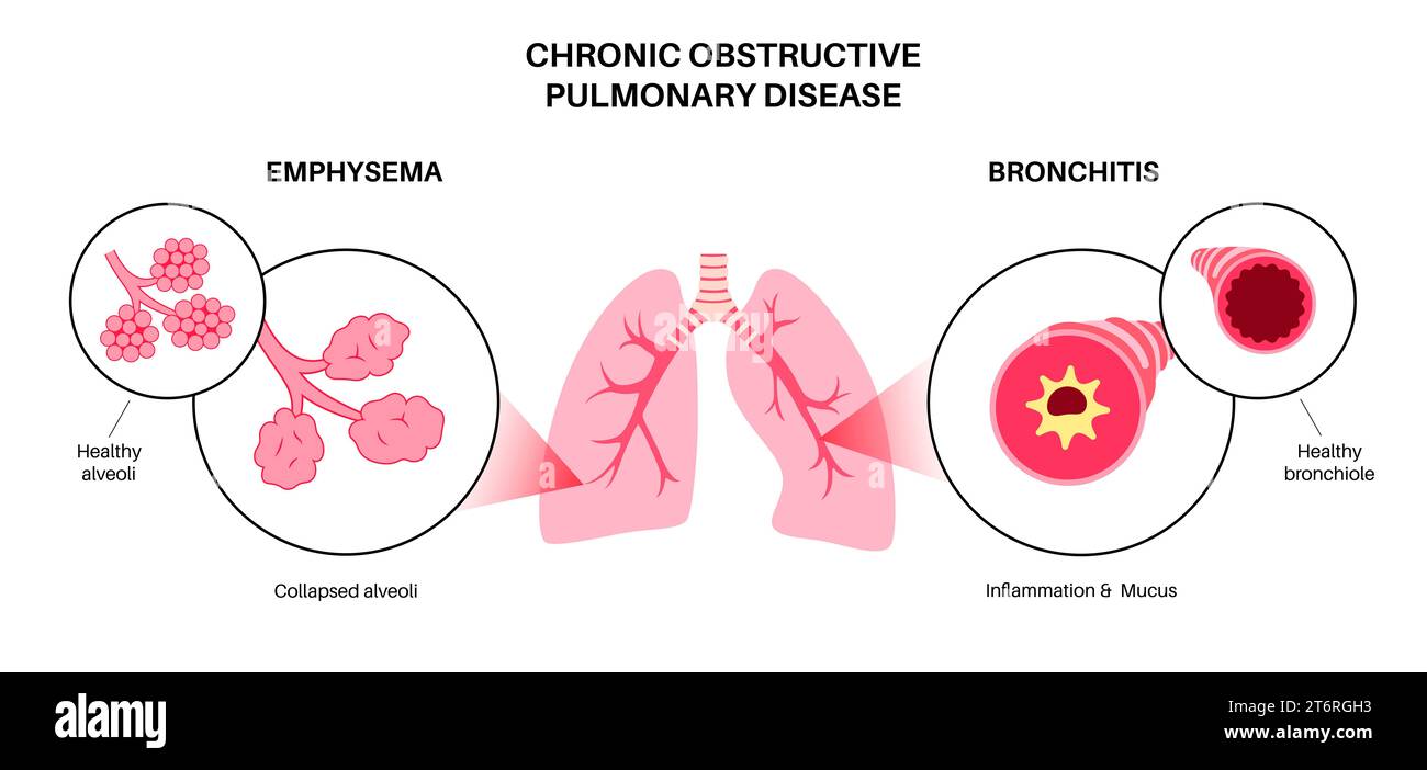 Chronic obstructive pulmonary disease, illustration Stock Photo - Alamy