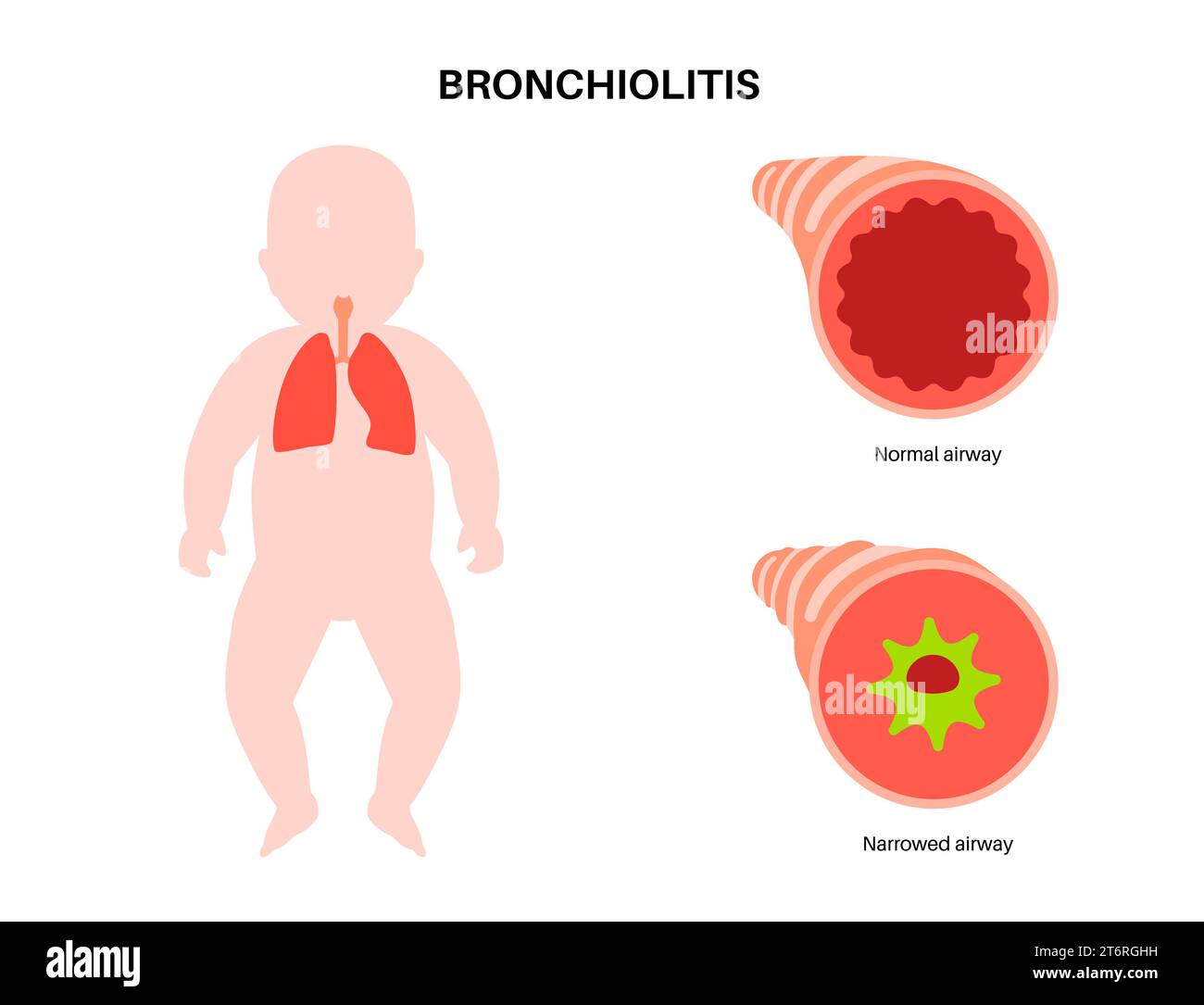 Bronchiolitis lung disease, illustration Stock Photo - Alamy