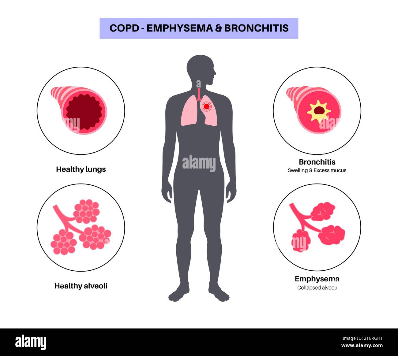 Chronic obstructive pulmonary disease, illustration Stock Photo - Alamy