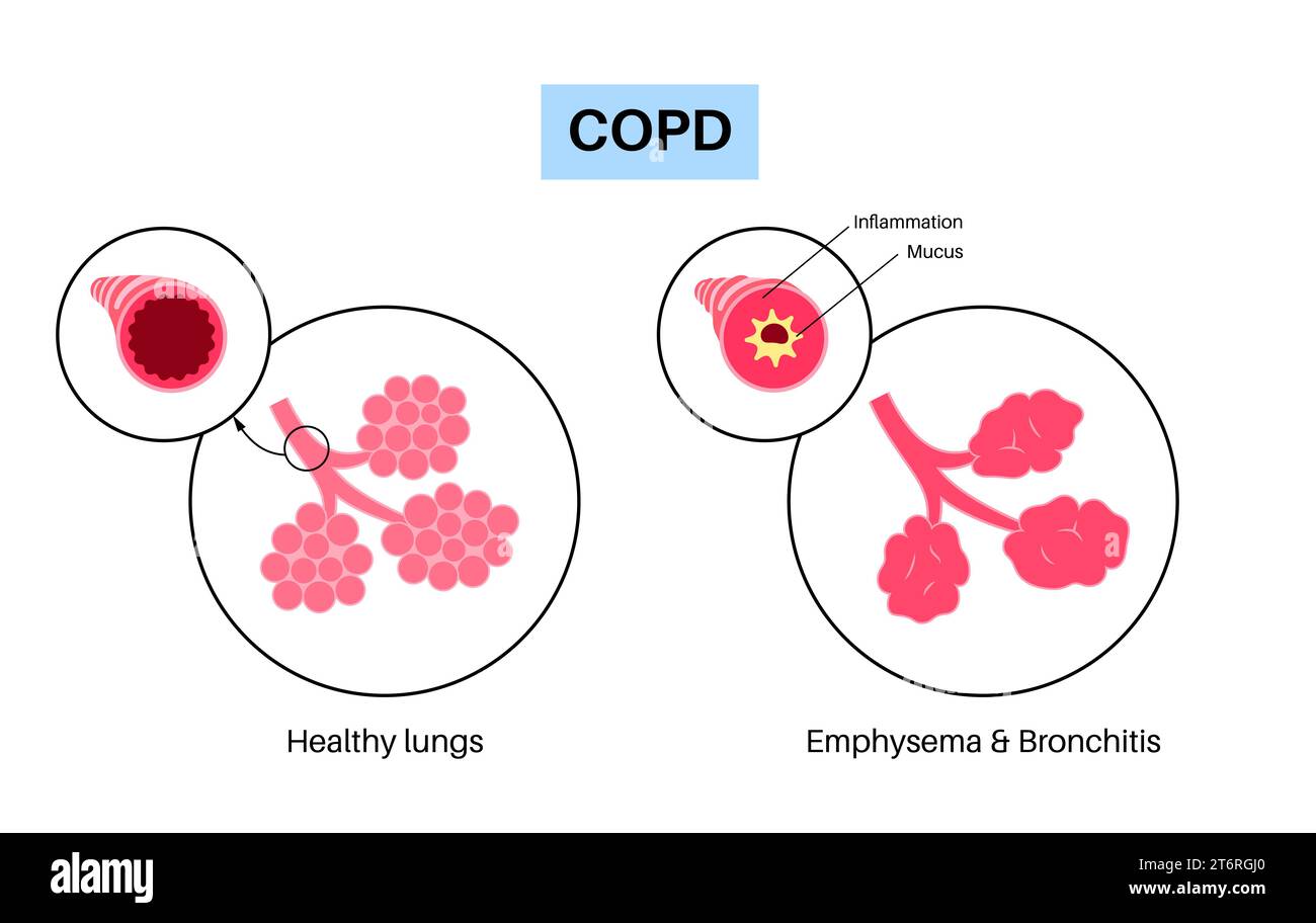 Chronic obstructive pulmonary disease, illustration Stock Photo - Alamy Chronic obstructive pulmonary disease, illustration Stock Photo - Alamy