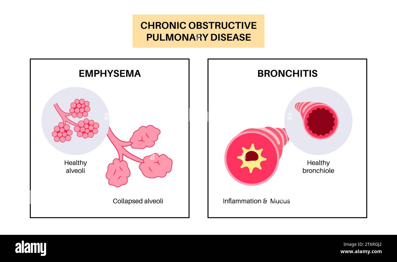 Chronic obstructive pulmonary disease, illustration Stock Photo - Alamy