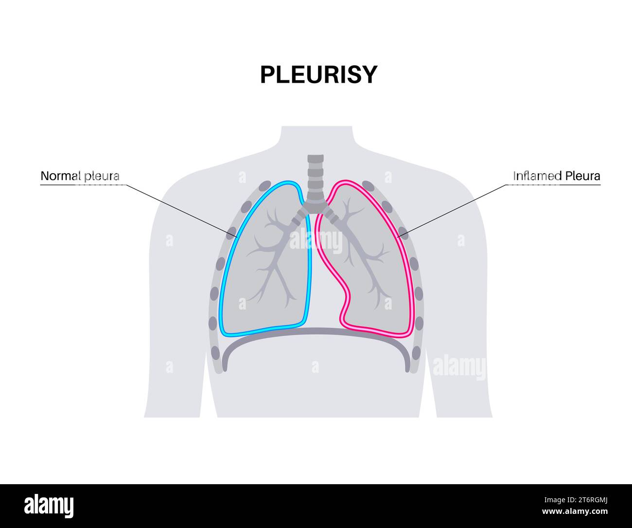 Pleurisy hi-res stock photography and images - Alamy