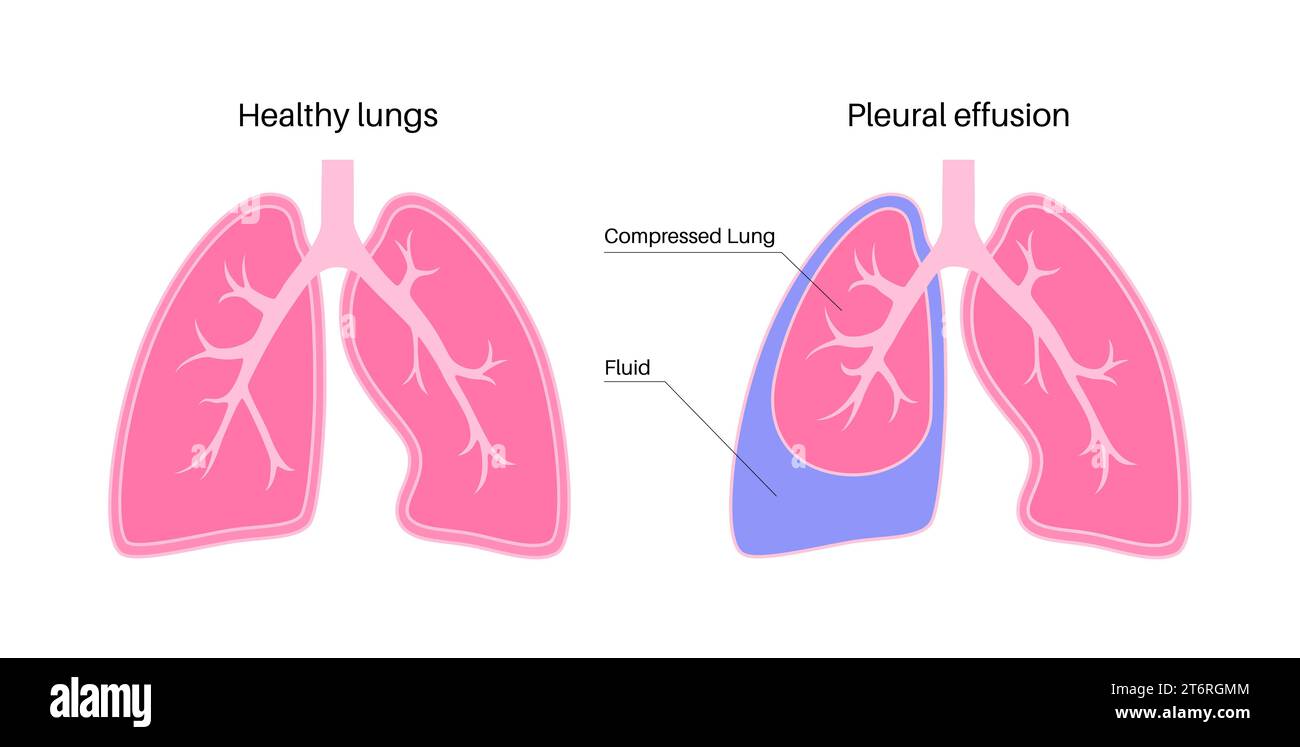 Pleural effusion, illustration Stock Photo - Alamy