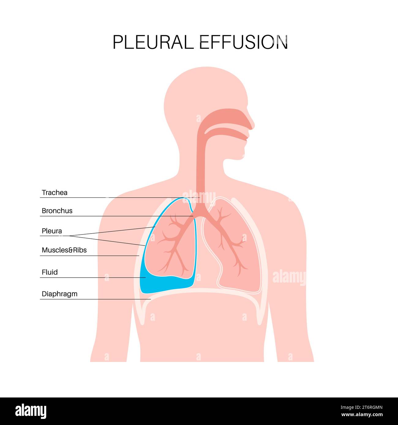Pleural effusion, illustration Stock Photo - Alamy