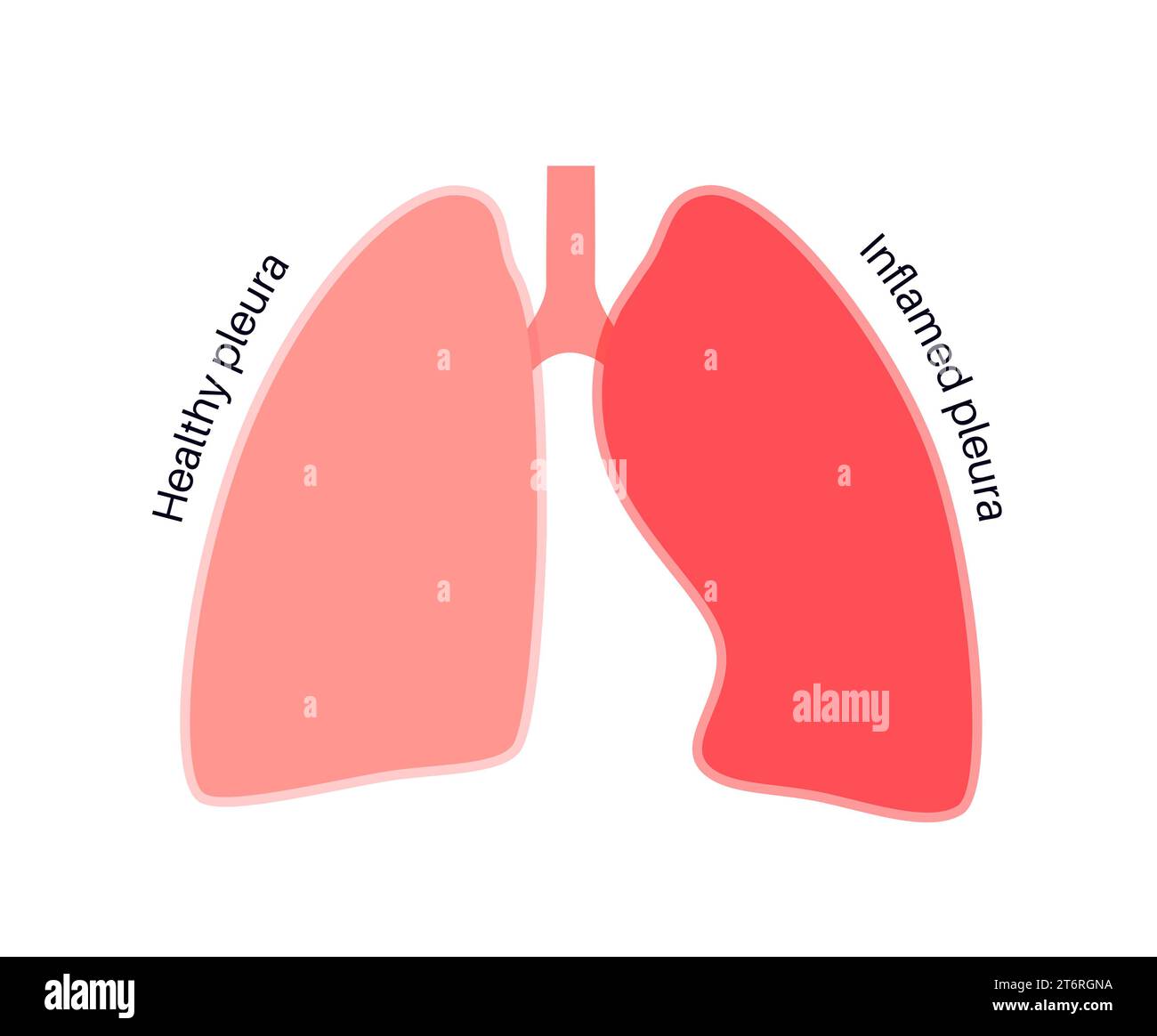 Pleurisy hi-res stock photography and images - Alamy