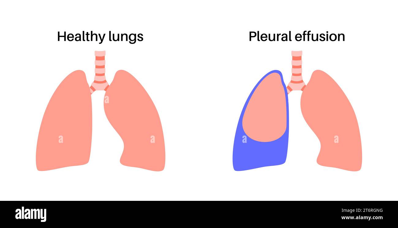 Pleural effusion, illustration Stock Photo - Alamy