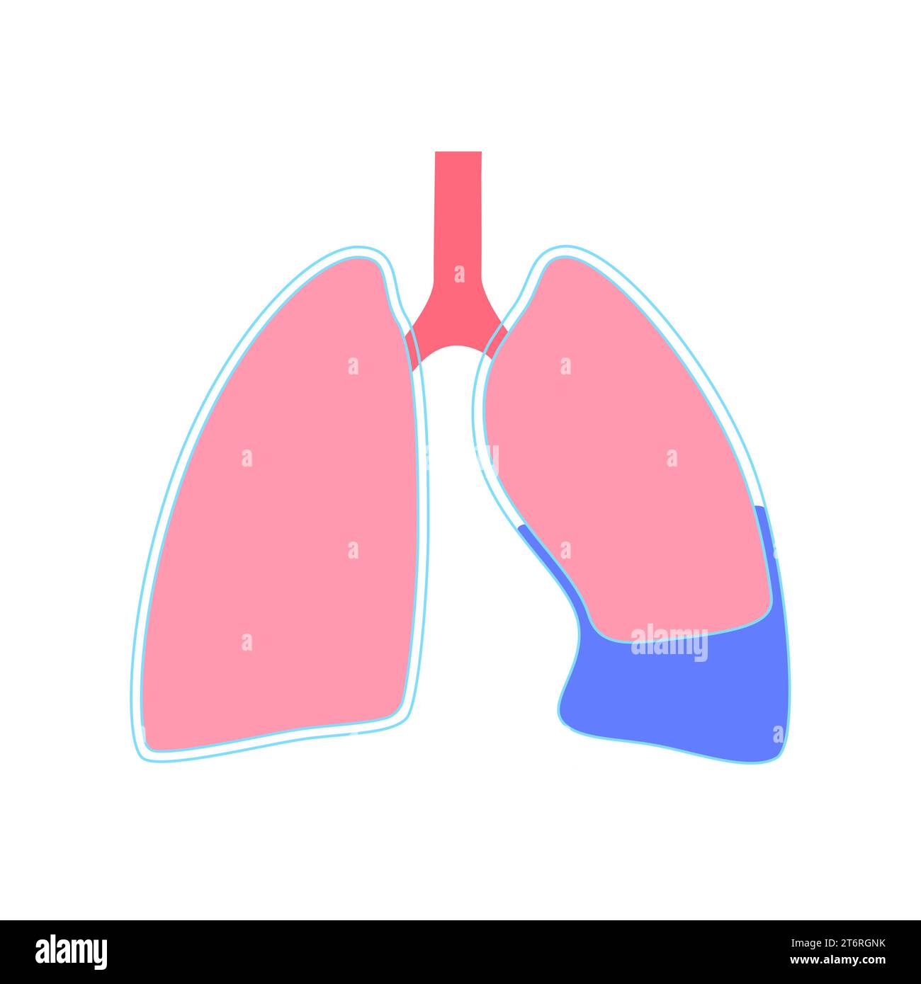 Pleural effusion, illustration Stock Photo - Alamy