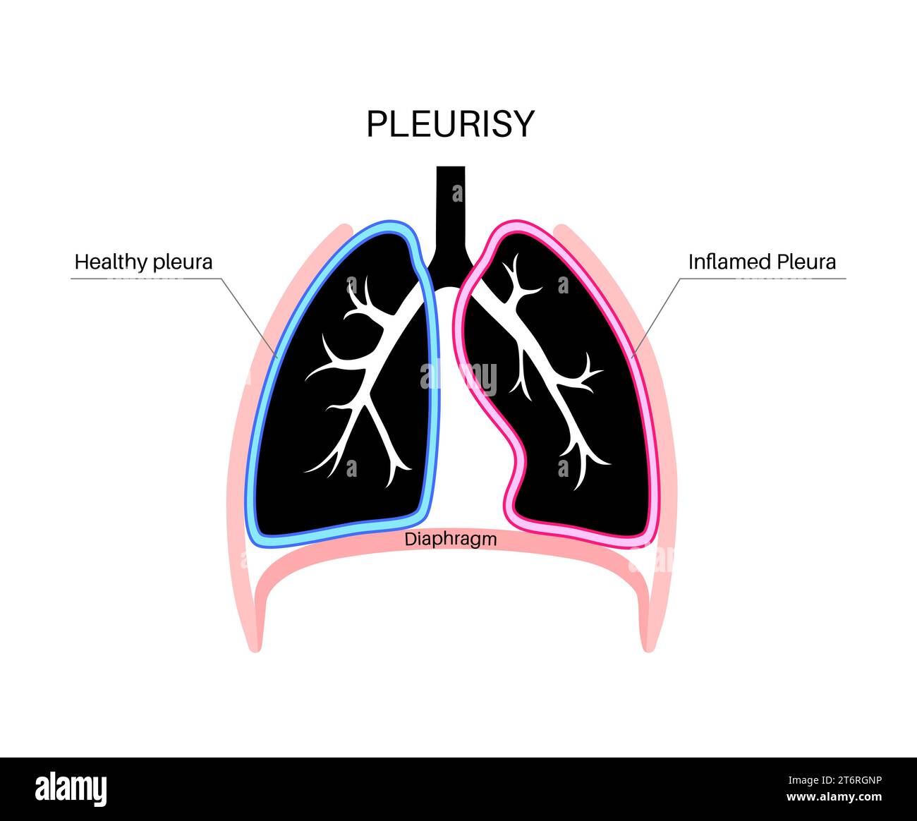 Pleurisy of the lung hi-res stock photography and images - Alamy