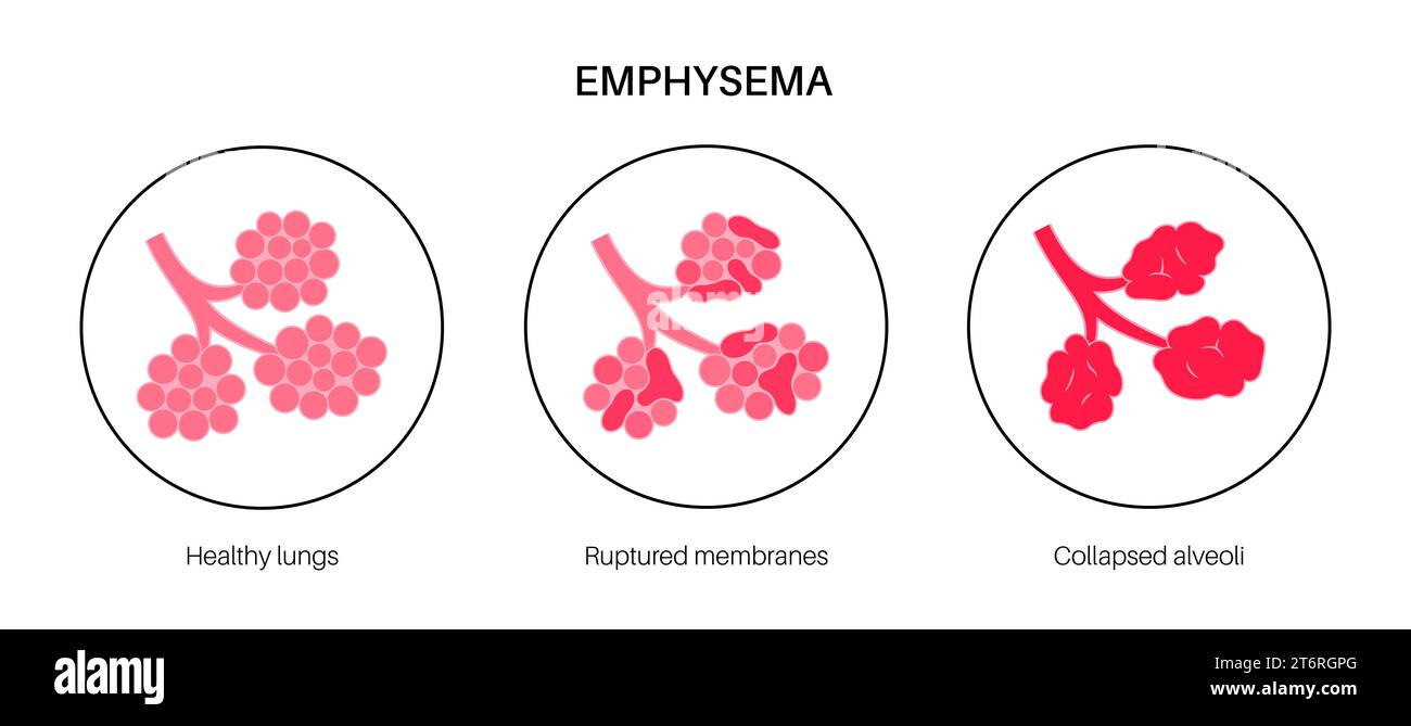 Emphysema hi-res stock photography and images - Alamy