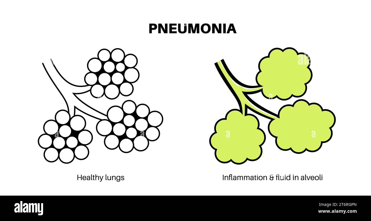 Illness pneumonia Cut Out Stock Images & Pictures - Alamy